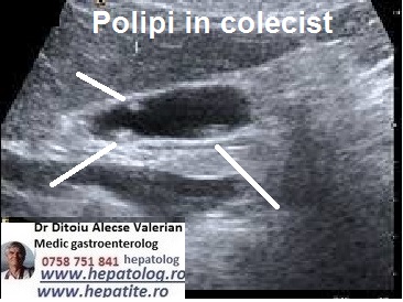 Colecist septat, colecist cudat, colecist malformat - Clinica de ...